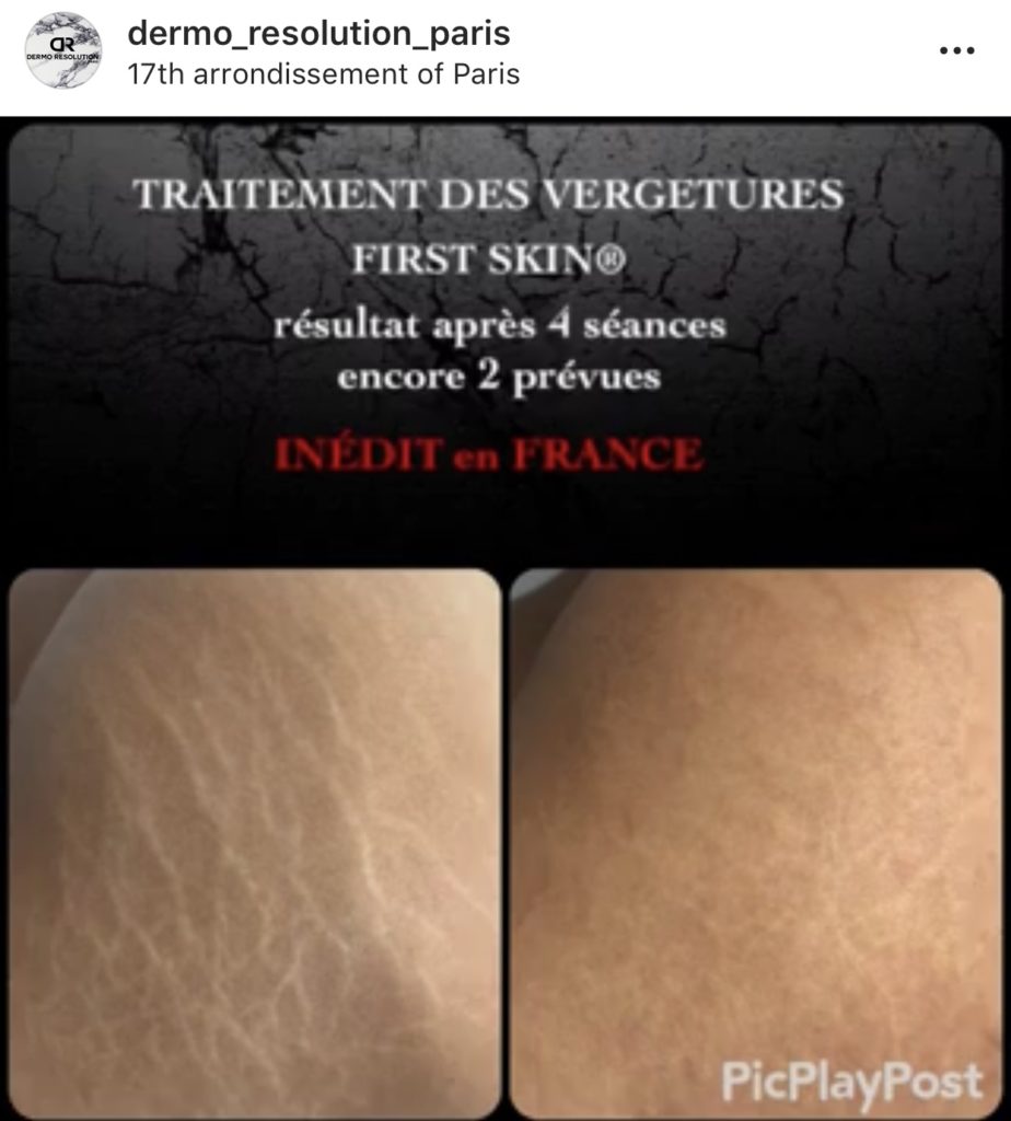 DERMOPIGMENTATION, la solution permanente pour faire disparaitre les ...